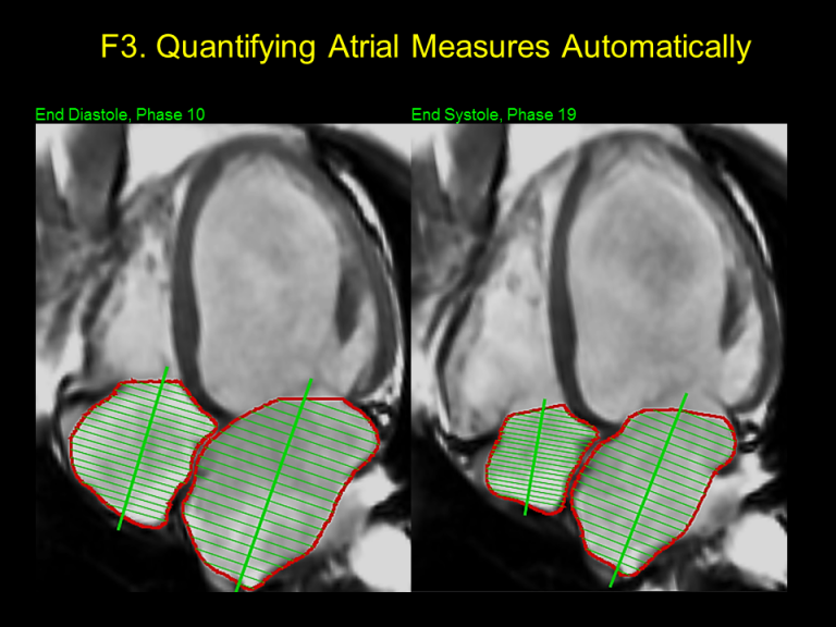Volumetric Measures - Cardiac MRI