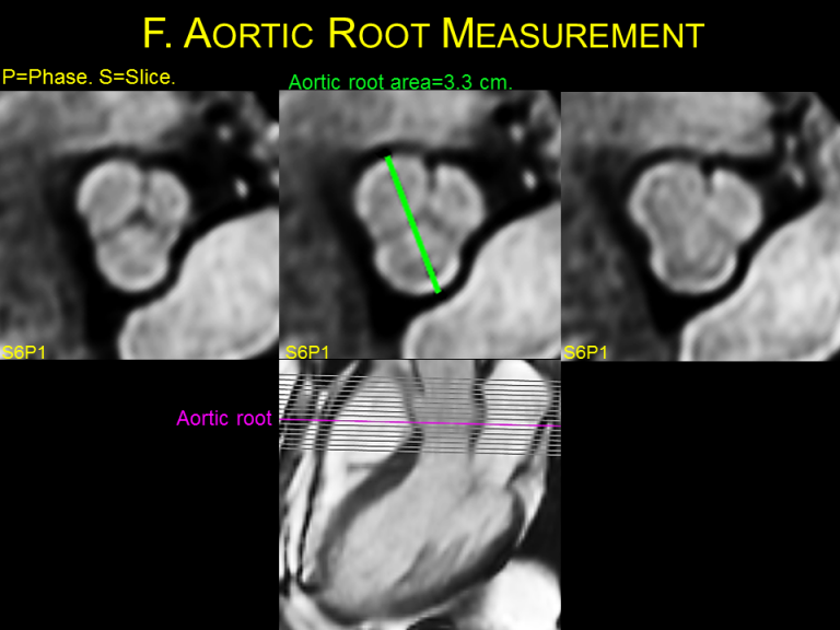 Aorta_aortic_root_measurement_cardiacMRI_AG_3272017 - Cardiac MRI