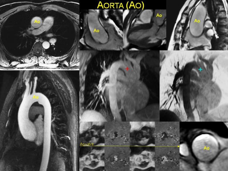 Aorta - Cardiac MRI