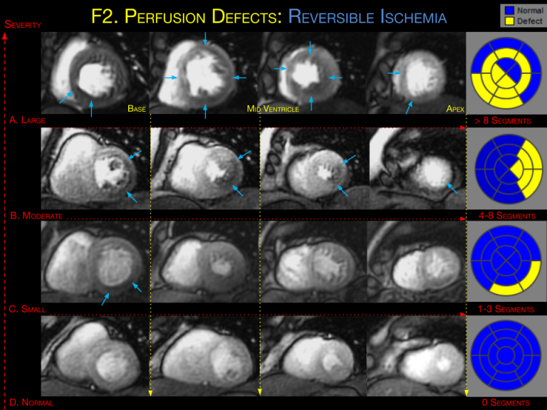 Left_ventricle_perfusion_defects_cardiacMRI_AG_5172017.pptx - Cardiac MRI