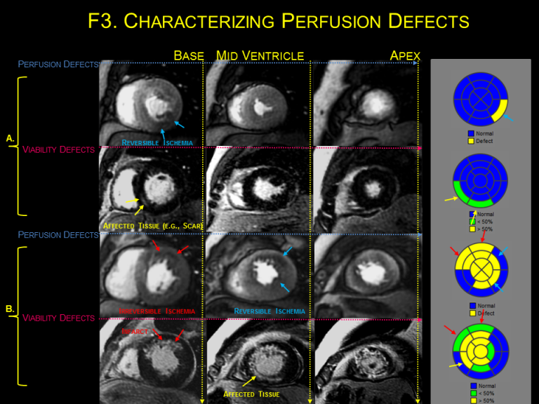 Myocardial Perfusion - Cardiac MRI